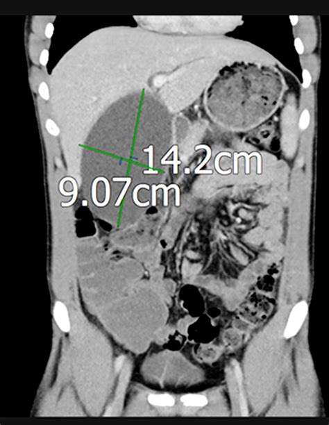 A Rare Case Of Gastric Outlet Obstruction Secondary To Hydrops Of
