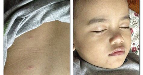 My Story Difference Between Measles And Chickenpox And RF