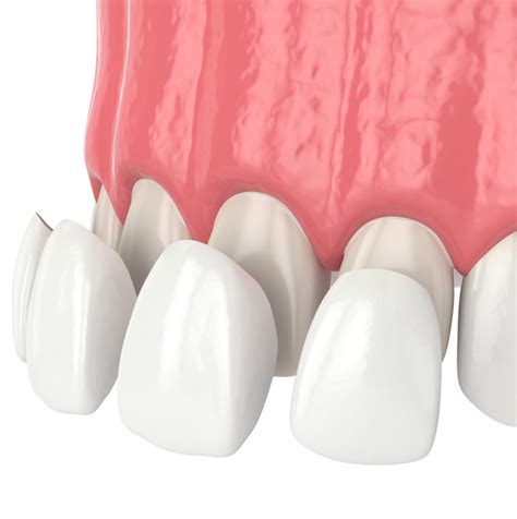 Laminate Veneers Transform Your Smile With Akkol Dental Affordable