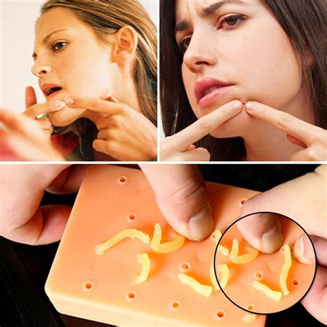 Pop It Pal Squeeze Acne Relief Toy Pimple Pimple Popping Toy Engraçado Removedor De Popper Pare