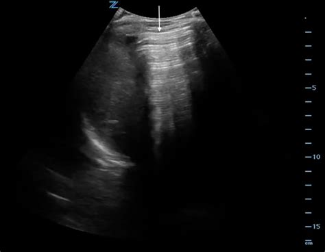 Timely Diagnosis Of Pneumoperitoneum By Point Of Care Ultrasound In The