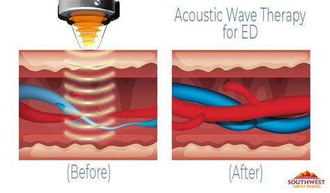 Wavetech Therapy Leading Acoustic Wave Therapy Providers My Master
