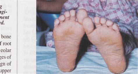 Soles Of The Feet Case 1 Showing Diffused Hyperkeratosis And Cracked
