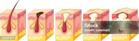Diagram Jerawat Pada Kulit Manusia Ilustrasi Stok Unduh Gambar