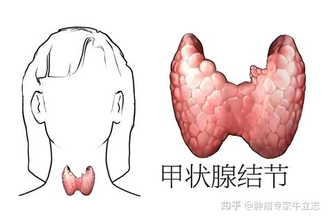 甲状腺结节4a，传统手术还是消融 知乎