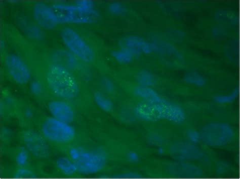 Pml Immunostaining On Paraffin Sections Of Mfh Patient No23 × 1000