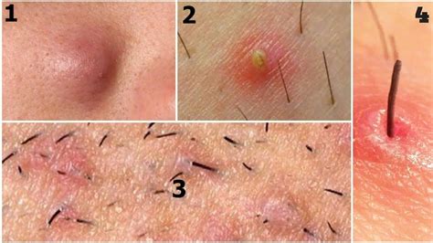 3 Simple Ways To Remove Deep Ingrown Hairs