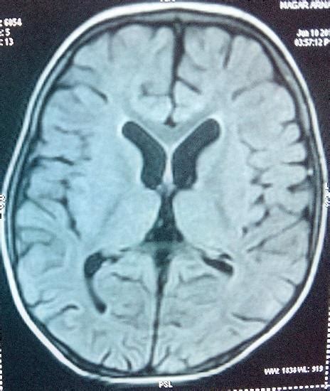 Plain Cranial Ct Non Contrast Download Scientific Diagram
