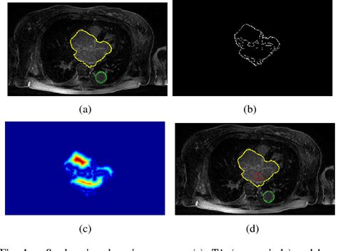 Figure 1 From Automatic Segmentation Of The Left Atrium From Mri Images Using Salient Feature