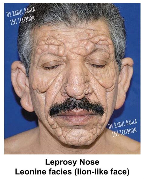 Granulomatous Conditions Of The Nose And Paranasal Sinuses Mbbs Notes Pdf