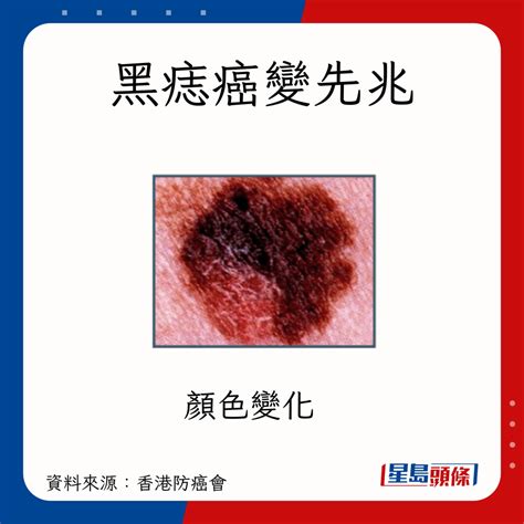 黑色素瘤｜醫生都中招 腳跟傷口半年後變皮膚癌 出現5種痣恐變晚期 星島日報