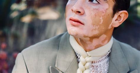 Vitiligo 개성 개인 스타일 남성 모델 남성 패션 다양성 독특한 스타일 독특한 아름다움 땋은 머리 레이스