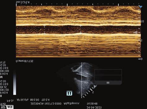 Ivc Ultrasound Imaging In The New Ultrasound Access In The Pron