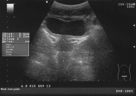 Bladder Ultrasound What To Expect Results Next Steps