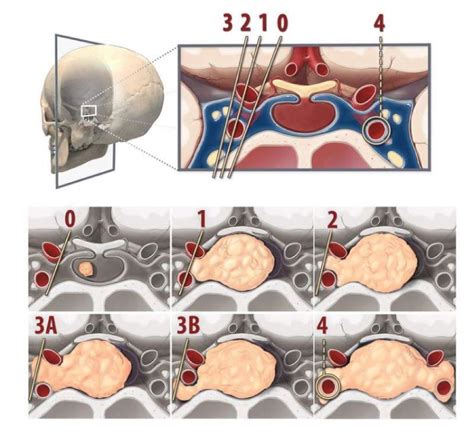 The Knosp Steiner Classification The Neurosurgical Atlas