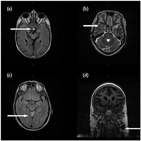 Examples Of Incidental Findings In The Lbc1936 A Pituitary Adenoma