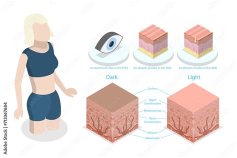 3d Isometric Flat Conceptual Illustration Of Albinism Compared Normal Skin Cross Section With
