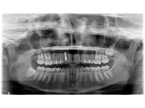 Aesthetic Complication On A Single Lateral Incisor Implant