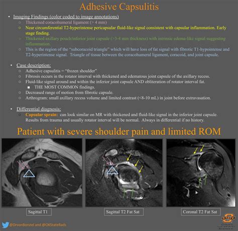 Frozen Shoulder Adhesive Capsulitis Signs Diagnosis T