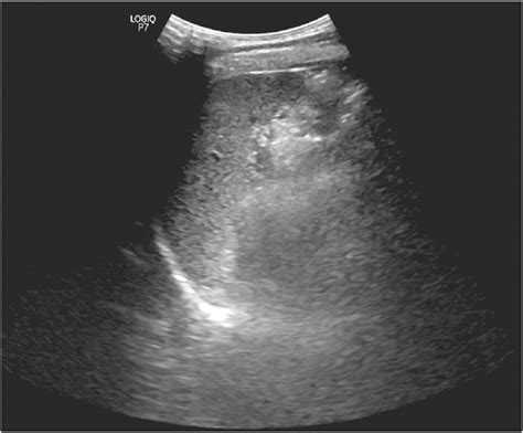 Ultrasound Spleen Image Obtained From A 21 Year Old Participant