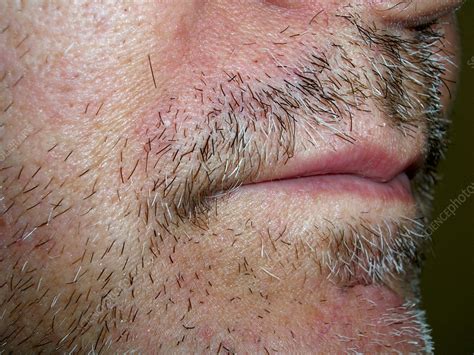 Seborrheic Dermatitis Stock Image C0565169 Science Photo Library