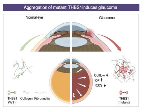 Pesquisa Identifica Nova Mutação Genética Por Trás Do Glaucoma Infantil