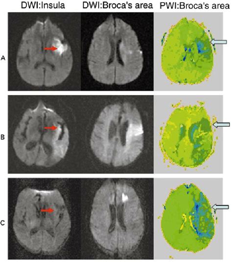 Dwi Left And Centre Scans And Pwi Right Scans Of Three Patients