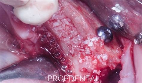 Injerto De Hueso Dental Implante Dental Con Injerto De Hueso Precio