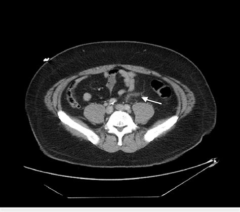 Transverse View Ct Abdomen And Pelvis With Delayed Imaging To Capture Download Scientific