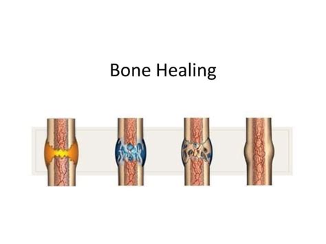 Bone Healing Pptx