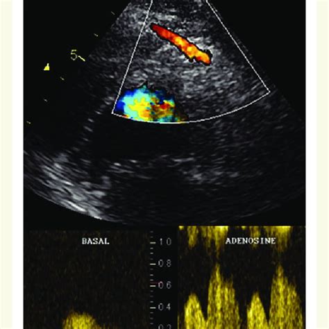 Example Of Lad Flow Visualization By Transthoracic Colour Doppler