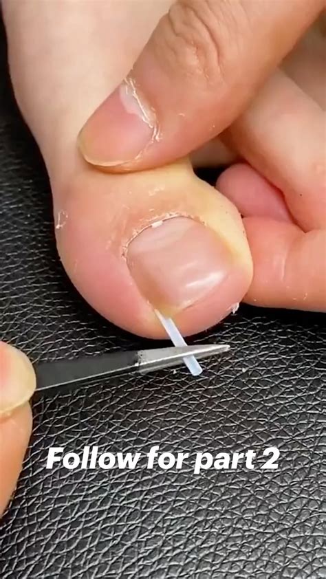 How To Apply Vicks To Toenail Fungus Artofit
