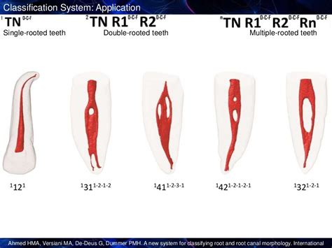 New Root Canal Classification System