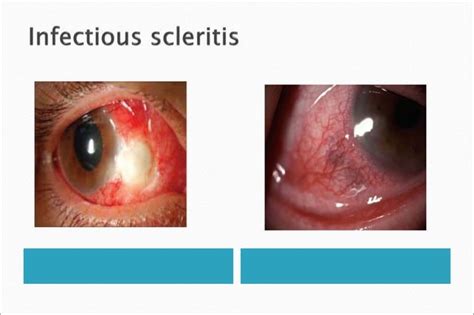 Scleritis Ppt