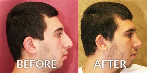 Liposuction Los Angeles Beverly Hills Lipo