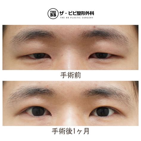 【目整形手術症例】ザ・ビビ整形外科 二重整形症例：男性二重整形 The Bb整形外科のブログ