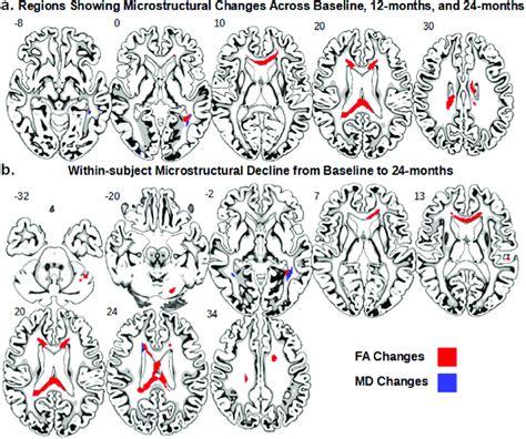 Whole Brain Voxel Wise Analysis Of Callosal Changes Across Months A