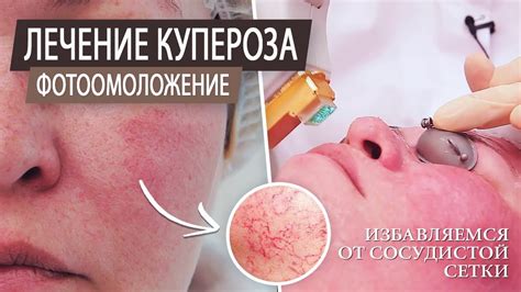 Фотоомоложение Лечение купероза на лице Чистка лица Аппаратная
