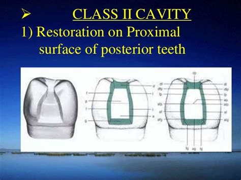 Principles Of Cavity Preparation By Dr Rupali