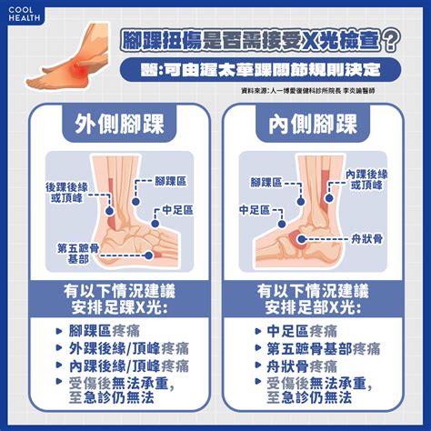 腳踝扭傷需要照x光嗎？ 醫揭判斷準則：疼痛發生在「這6處」必檢查