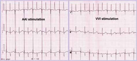 Figure 2 From Spontaneous Pacemaker Distal Lead Tip Migration Resulting