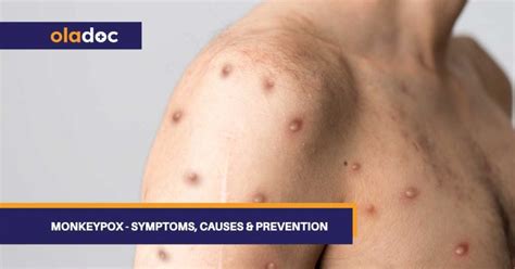 Monkeypox - Symptoms, Causes & Prevention