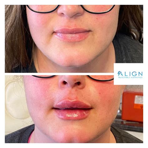 Versa Lip Filler