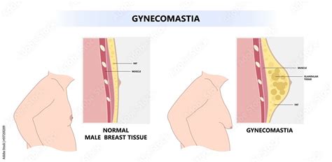 Lateral Of Gynecomastia Man Obesity With Fat Tissue On The Chest