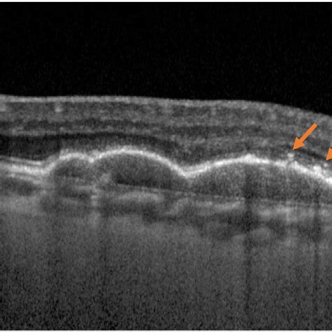 Representative Oct B Scan Demonstrating Hyperreflective Foci Orange