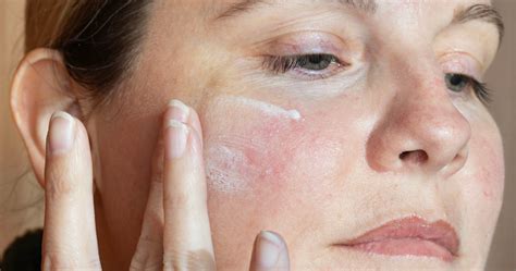 Theres No Real Cure For Rosacea But There Are Ways To Tame Flare Ups