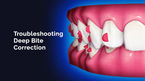 Troubleshooting Deep Bite Correction Invisalign Bite Correction