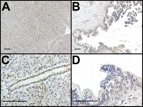 Hnf6 Expression In Normal And Diseased Human Pancreas Tissue Download