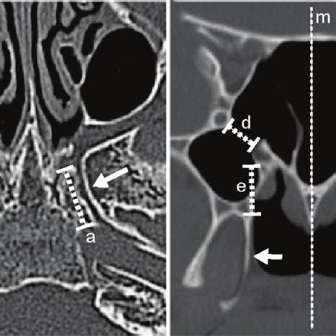 A Axial Computed Tomography Ct Scan Slide Showing Measurements
