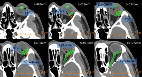 Target Polygons And Organs At Risk Oars Used For This Experiment The